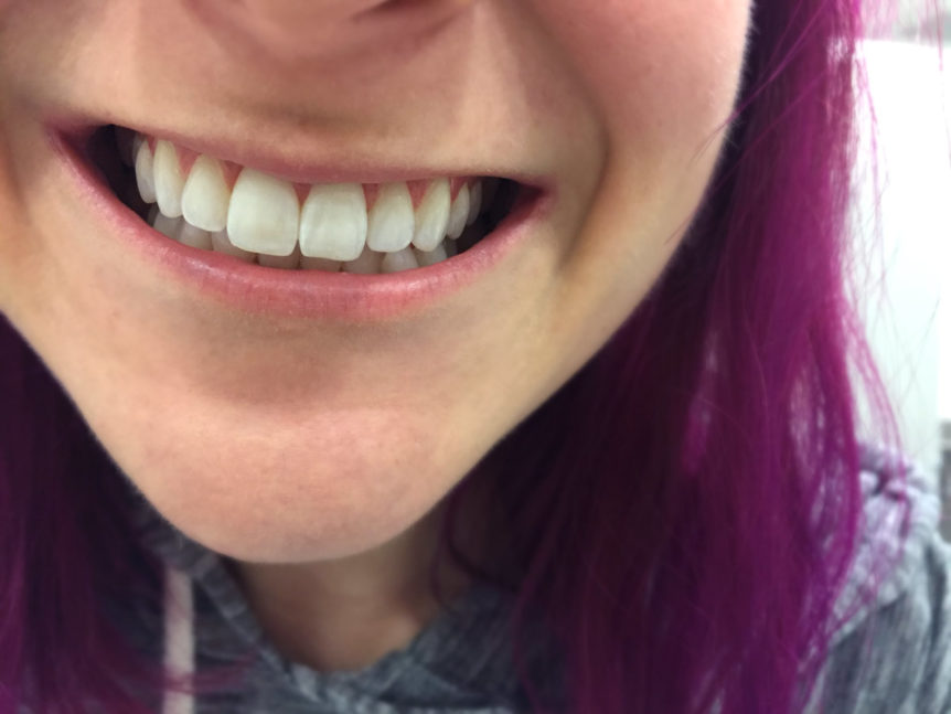One Woman's Quest for the Whitest Teeth Ever, A Smile Brilliant Review ...